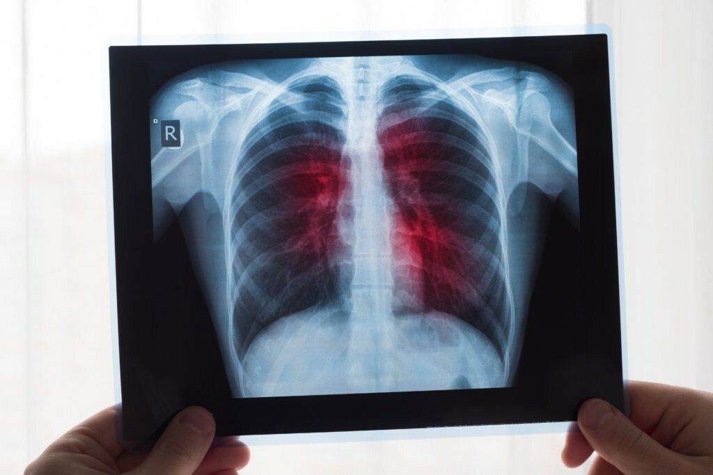 Tuberculosis resistente a los antibióticos: un problema mundial | CAEME